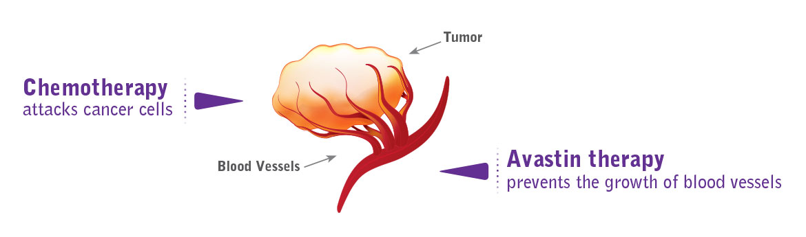 Avastin® (bevacizumab) differs from chemo for metastatic colorectal ...